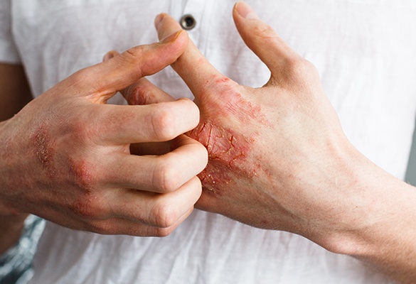 Psoriasis & CAP - LCC Hospital